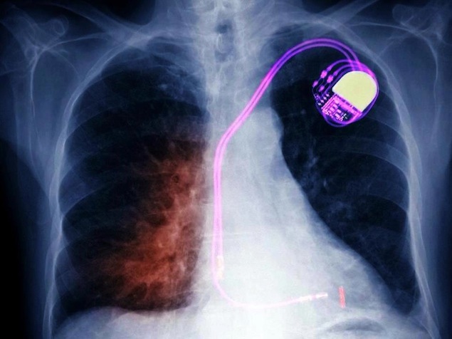 Have You Ever Had A Pacemaker Explode During Cremation? | Connecting ...